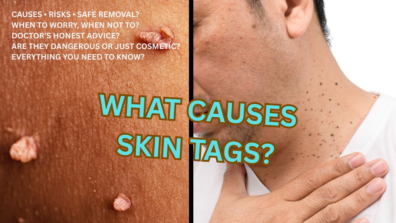 Skin Tags Explained | Doctor’s Advice on Causes & Safety - YouTube