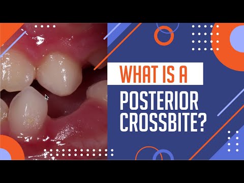 What is a Posterior Crossbite? https://www.straightsmilesolutions.com ...