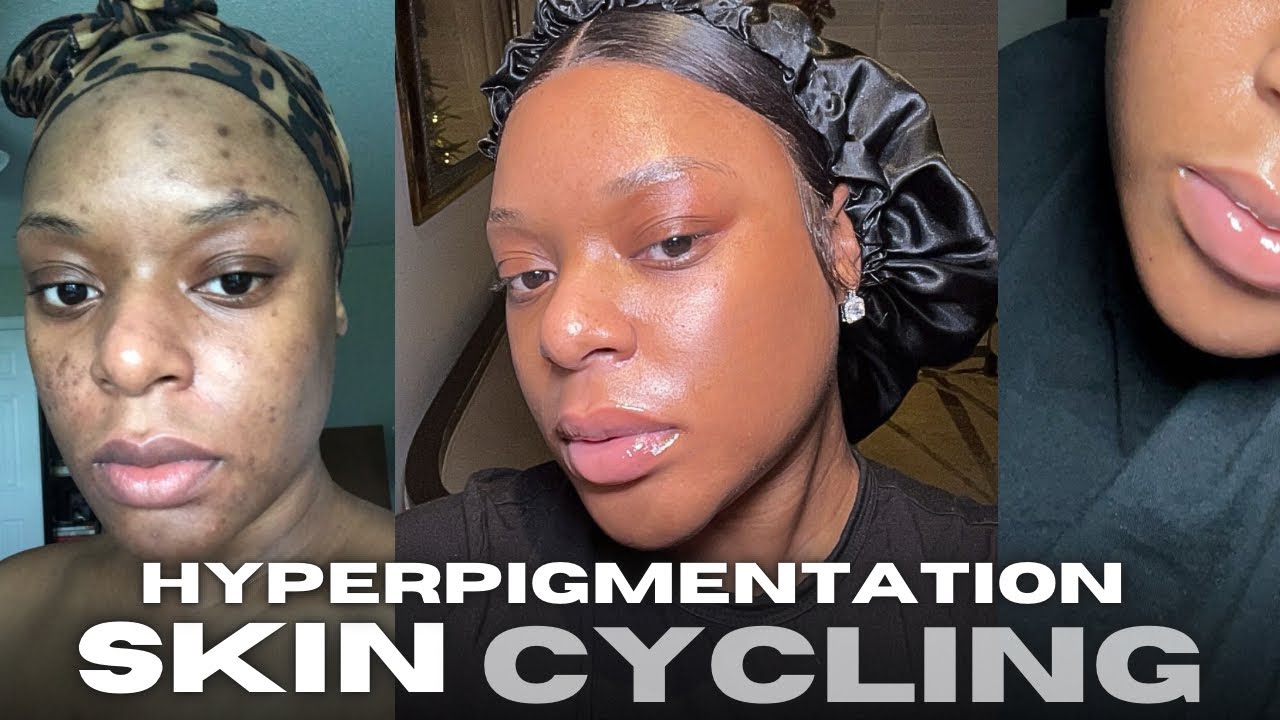 HOW TO CLEAR YOUR HYPERPIGMENTATION WITH SKIN CYCLING - YouTube