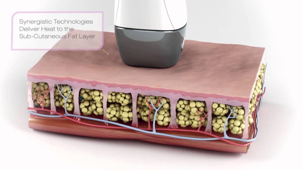 How does Velashape work? (Animated) - YouTube