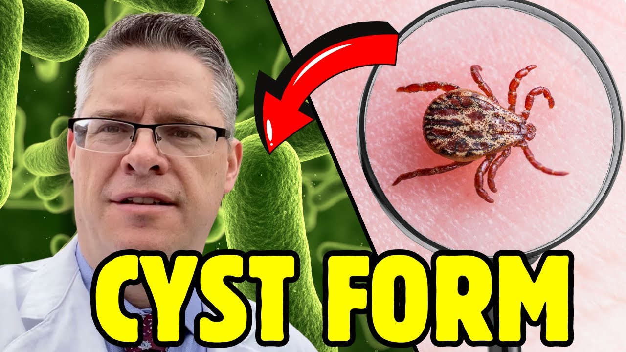 Lyme Disease's Hidden Threat - From Stealth Mode to Cyst Form - YouTube