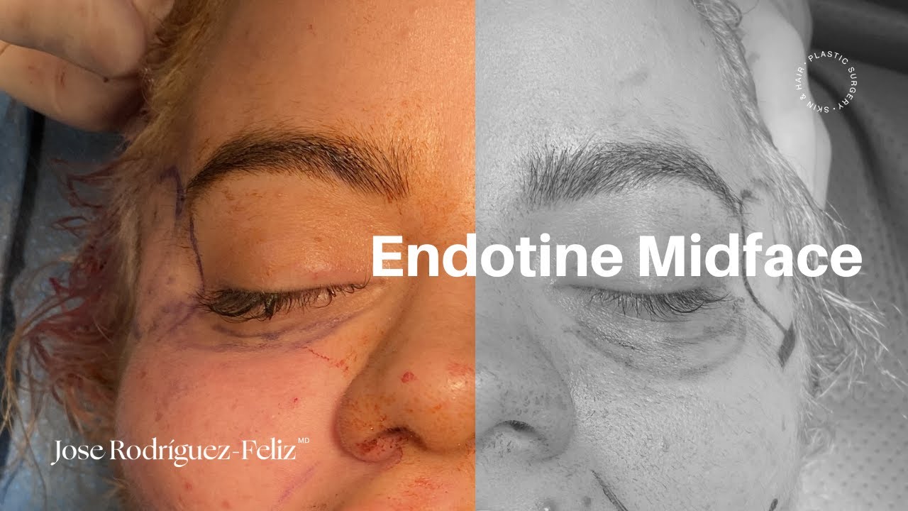 Endotine Midface - YouTube