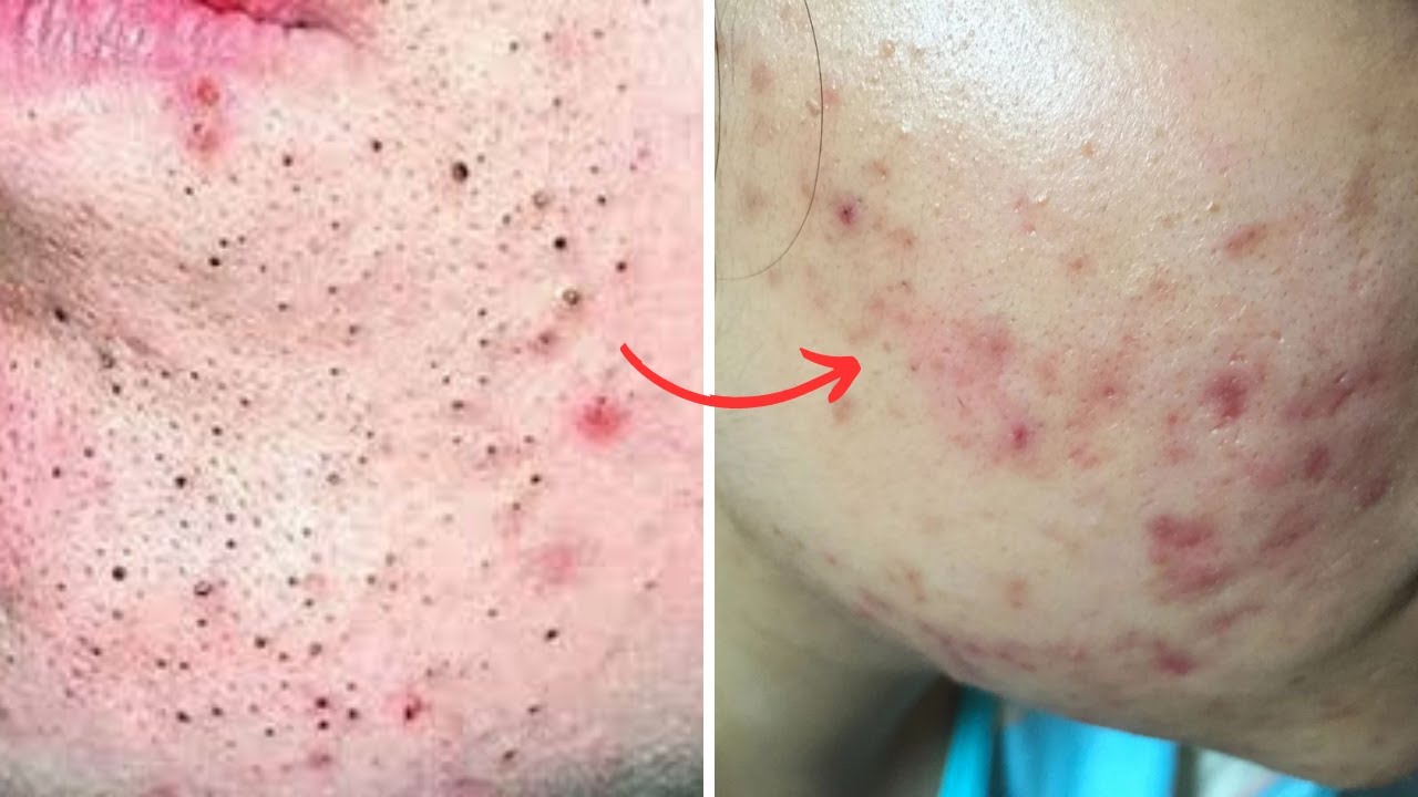 REMOVENDO CRAVOS GIGANTES NO ROSTO!! - YouTube