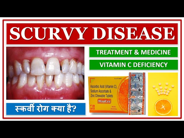 Scurvy Symptoms And Causes
