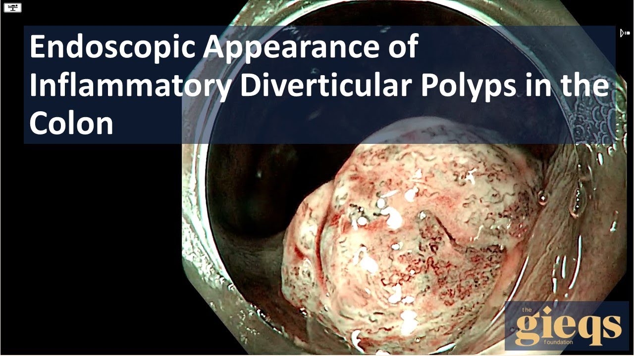 Endoscopic Appearance of Inflammatory Diverticular Polyps in the Colon ...