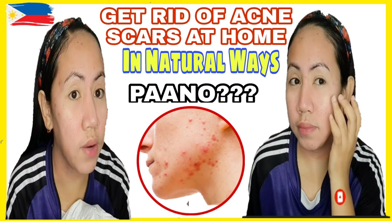 Effective Ways to Get Rid Of Pimple Acne Scars || Filipina Beauty ...