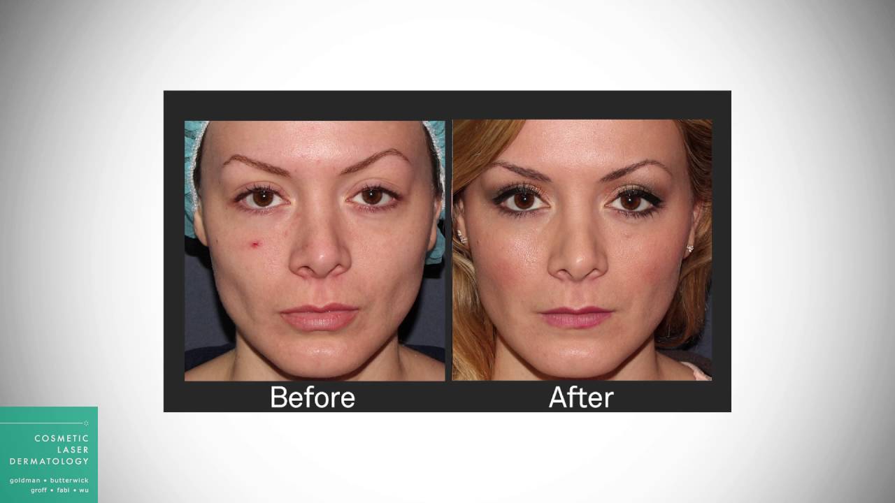 Restore Lost Facial Volume with Voluma - YouTube