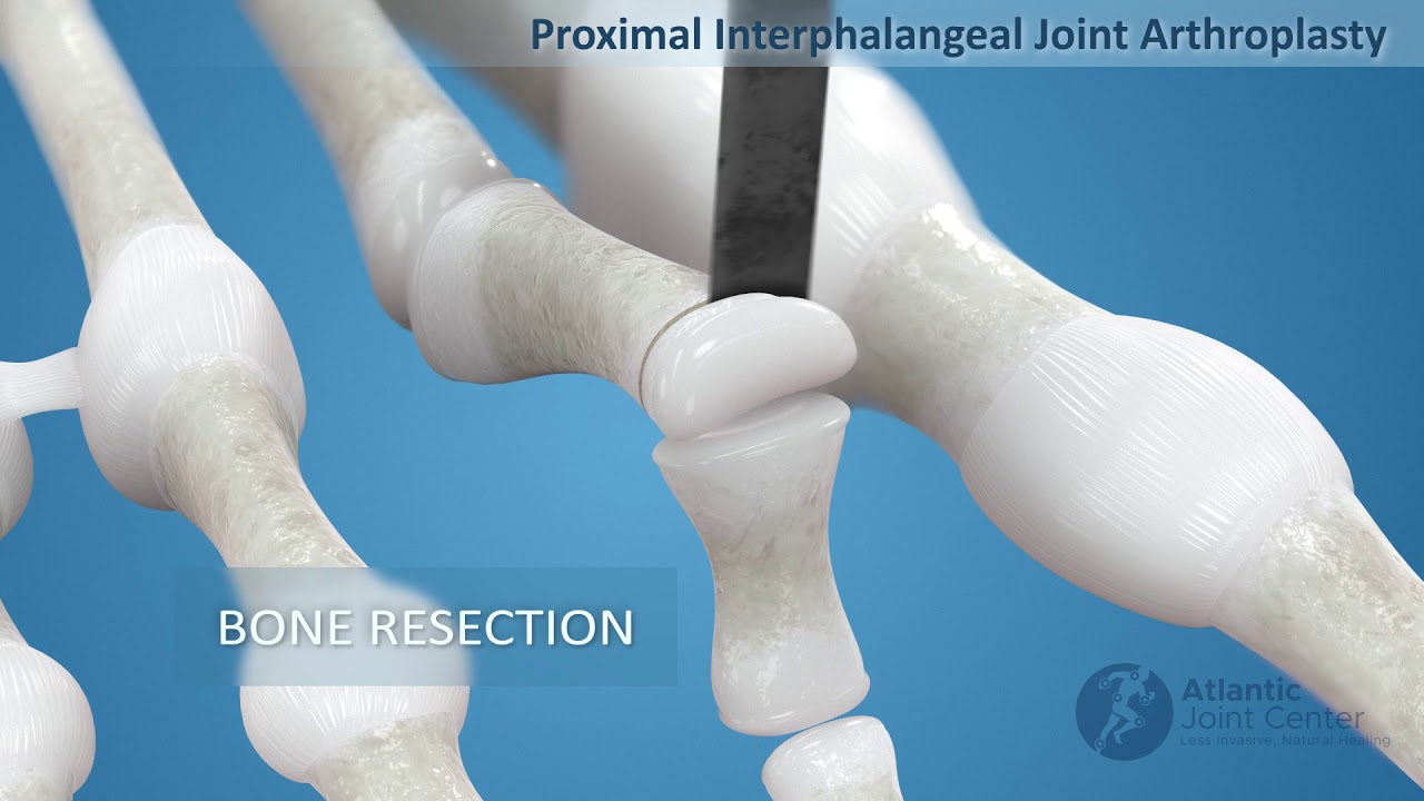Hammertoe PIPJ Arthroplasty Treatment - YouTube