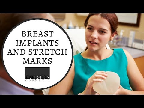 Breast Implants And Stretch Marks | Edelstein Cosmetic