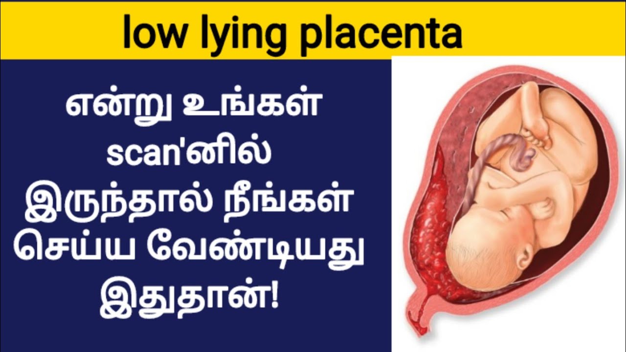 Low Lying Placenta In Tamil Nanjukodi Irakkam In Tamil Pregnancy Tips In Tamil Normal low-lying-placenta-in-tamil-nanjukodi-irakkam-in-tamil-pregnancy-tips-in-tamil-normal