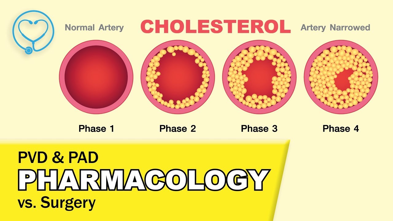 PAD vs PVD animation TOP 3 tested pharmacology treatments & Surgery ...
