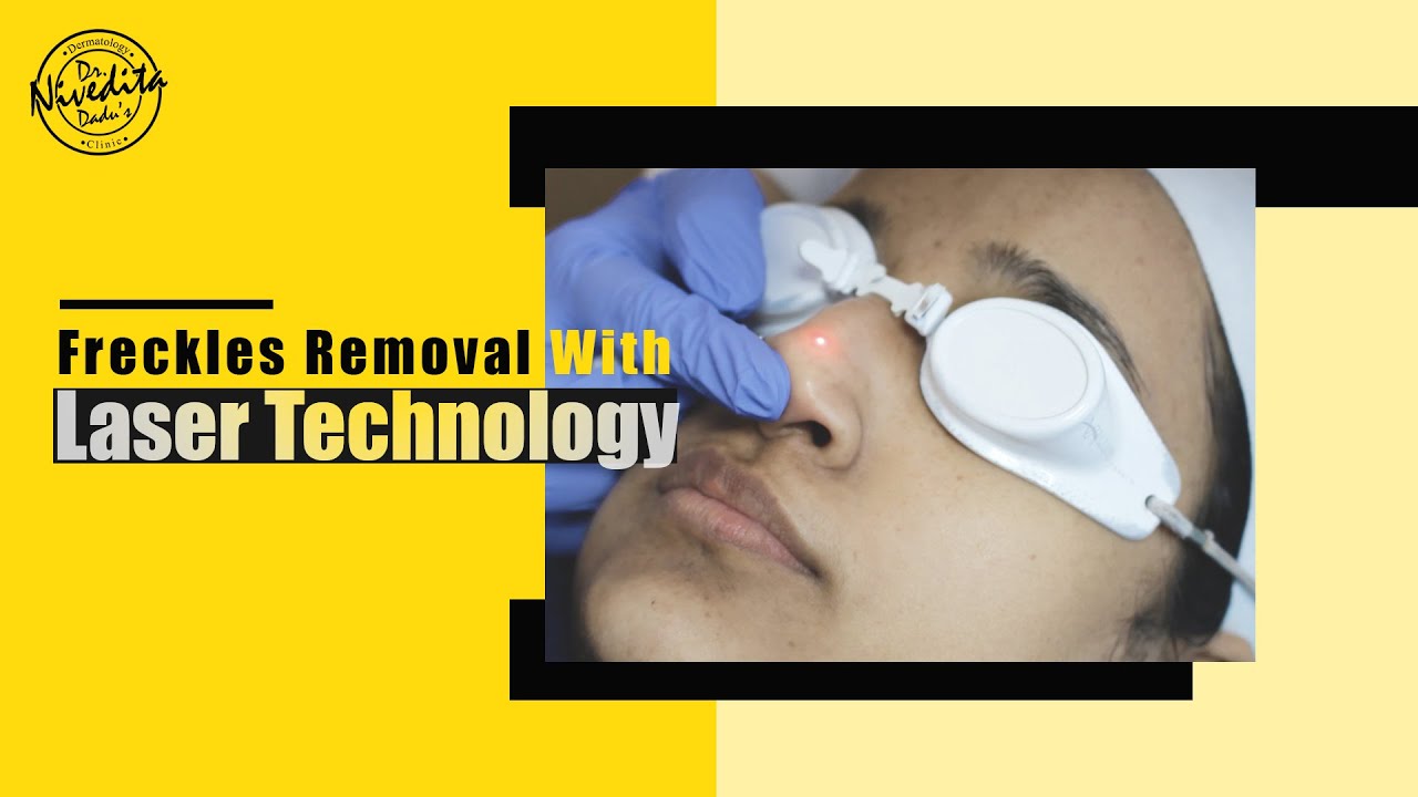 चेहरे से झाई कैसे हटाये | Freckles Removal With Laser Technology - YouTube