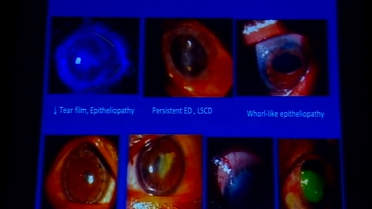 AIOC2018 - GP029 - Topic - Drop in Vision after Successful Corneal ...