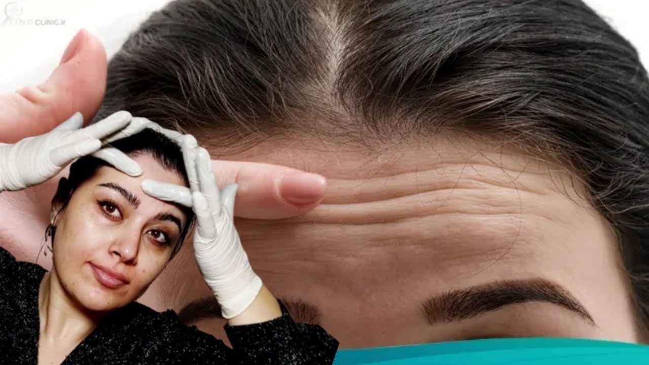 Proper forehead massage training to remove forehead wrinkles(Anti-Aging ...