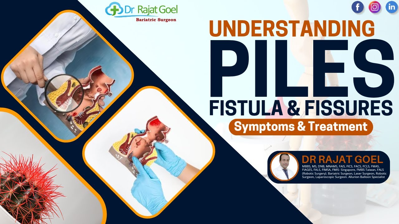 Understanding Piles, Anal Fissures, and Fistulas | Piles Treatment in ...