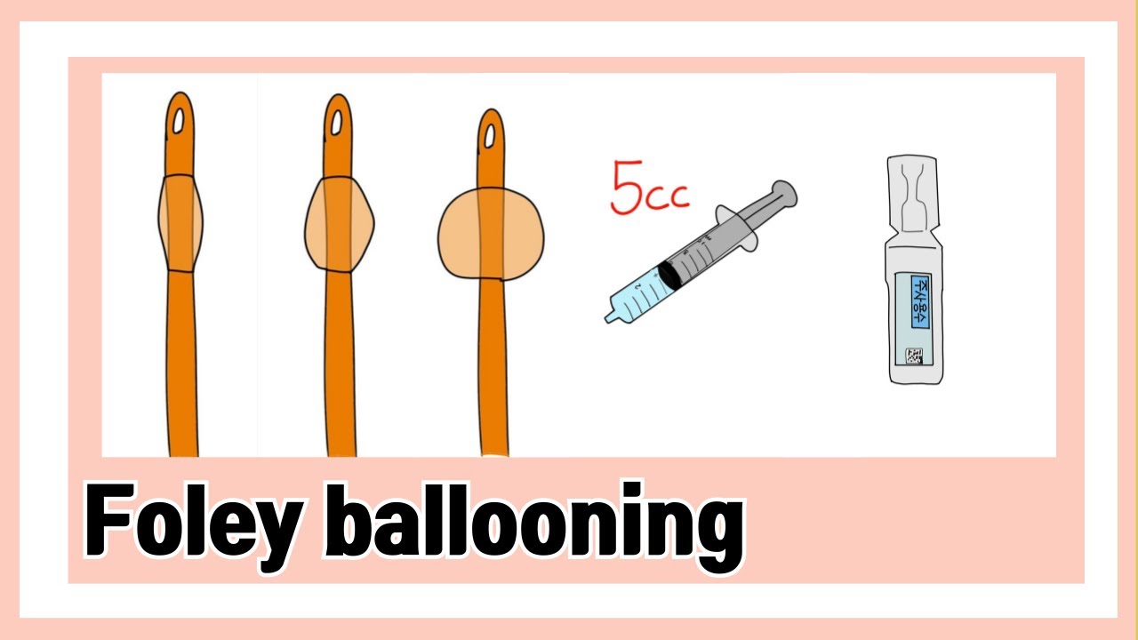 foley ballooning 핵심 2가지#foley - YouTube
