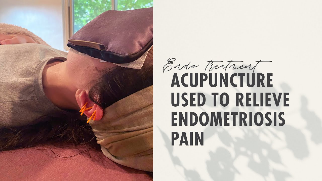 Using Acupuncture to Treat *ENDOMETRIOSIS PAIN* - YouTube