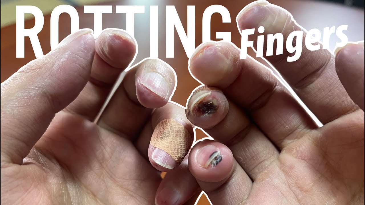 My Battle Against My Sickness | Raynaud's Disease - YouTube