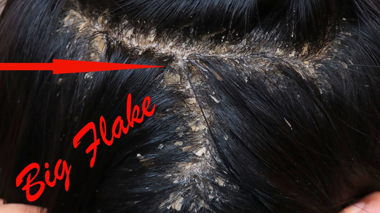 Scratching Dandruff Off Scalp Satisfying Big Dandruff Flakes Removal