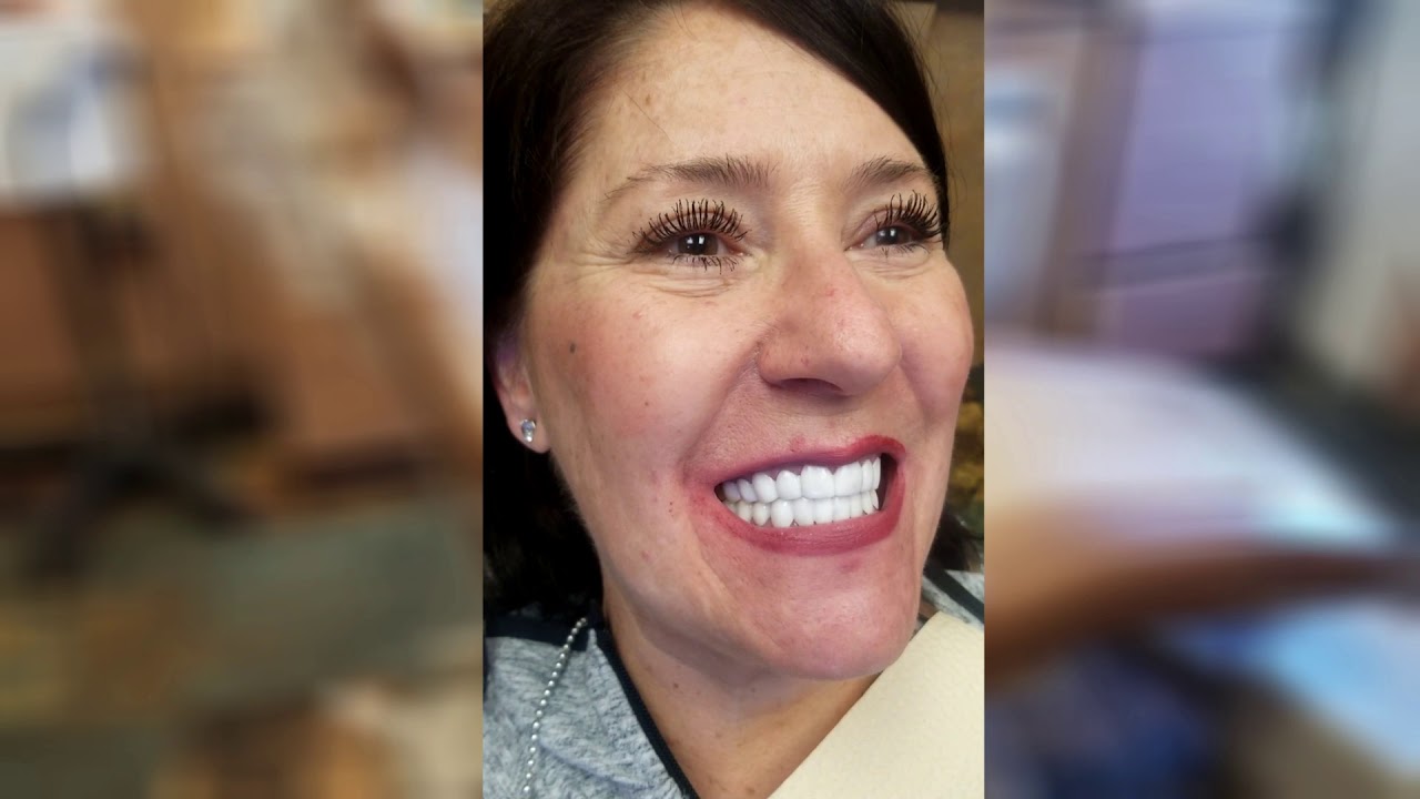 The Magic of Snap On Smile - a DenMat Lab Professional Product - YouTube