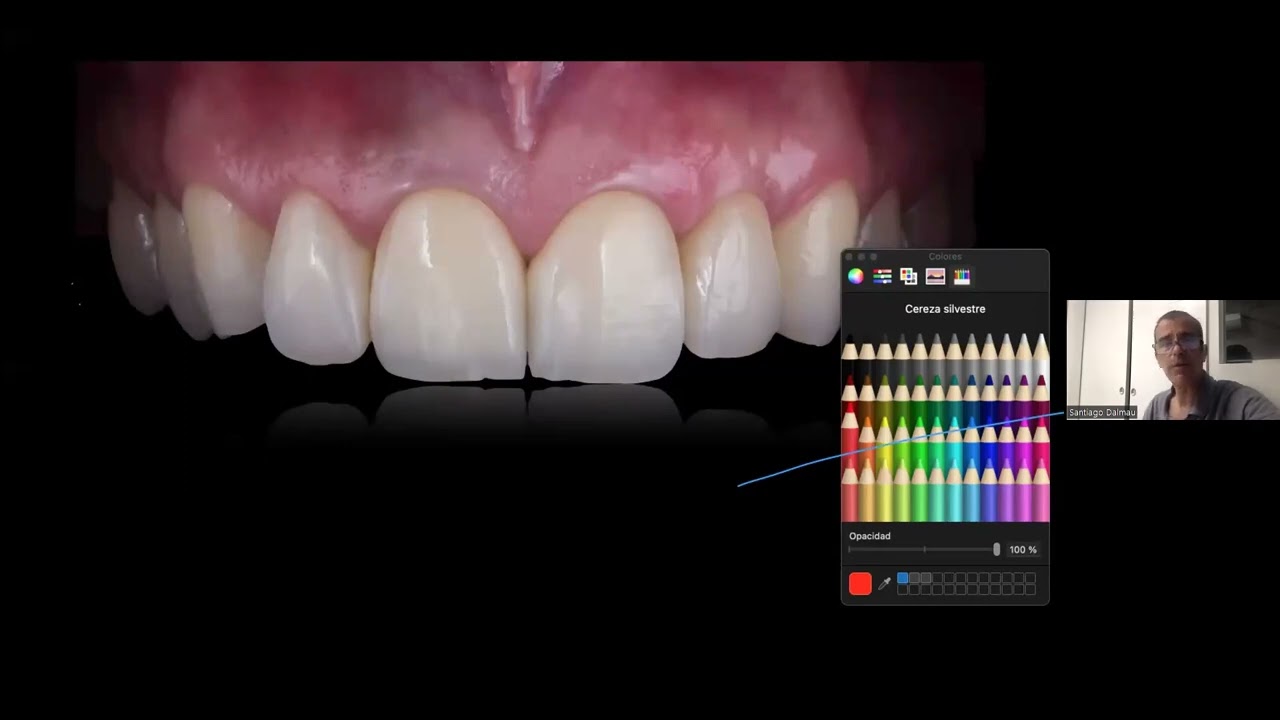 【20220508】Ezneer Esthetics with Zirconia -Santiago - YouTube