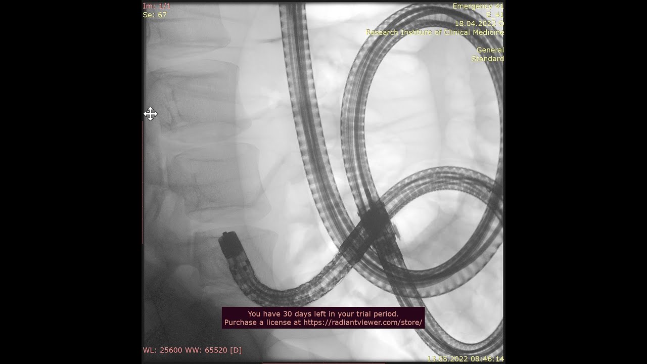 Motorized Spiral Enteroscopy - Todua Clinic - YouTube