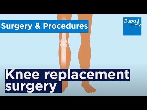 How knee replacement surgery is carried out | Bupa Health