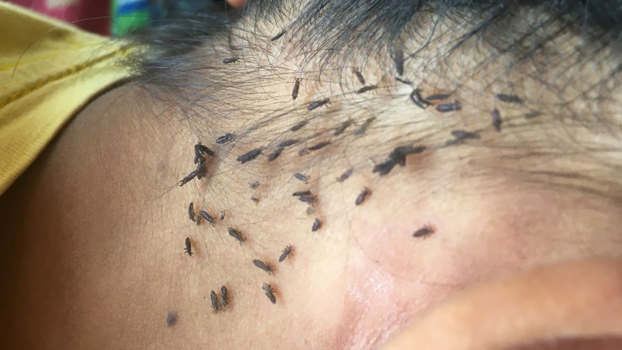 Get rid all hundred head lice - How to pick out all big head lice - YouTube