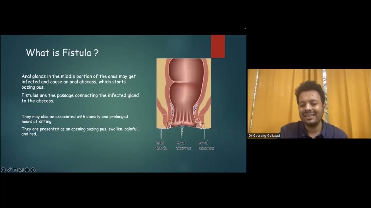 Homeopathy for Piles, fissures and fistulas. - YouTube