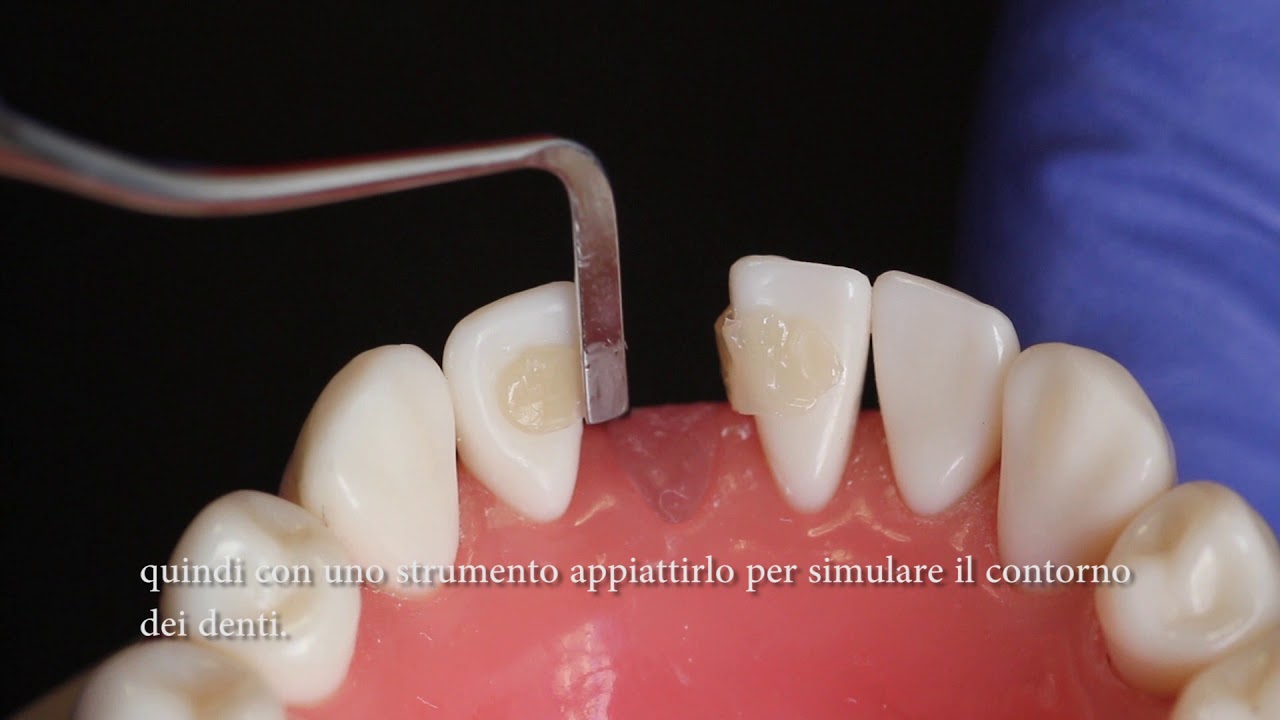 Ribbond Bridge Technique Italian Audio and Text - YouTube