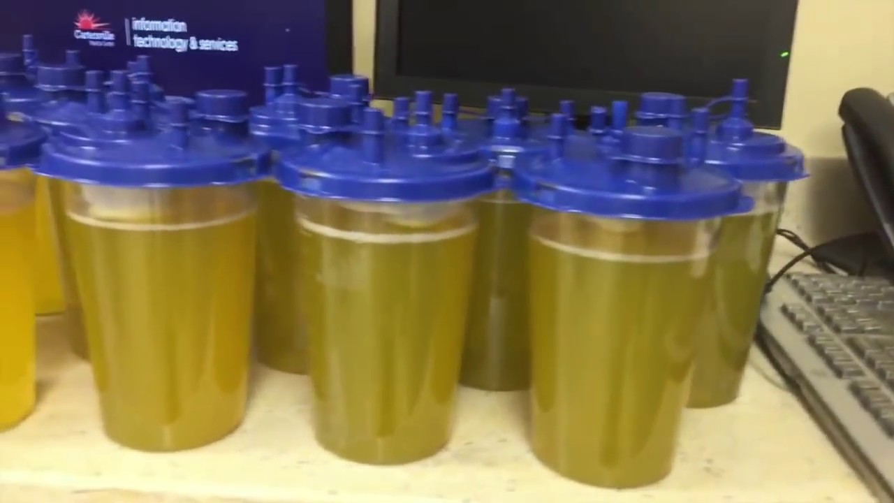 Draining Fluid! 4 Gallons Drained by Dr. ER (Discussion) - YouTube