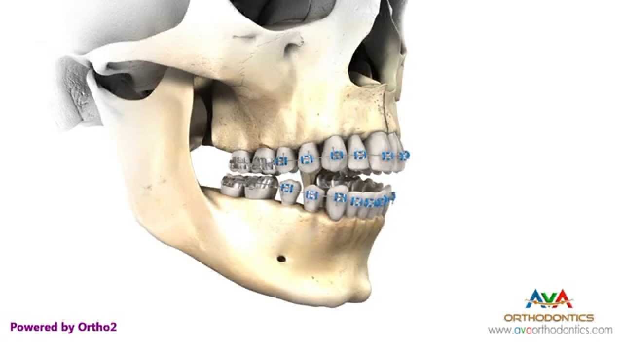 Surgical Orthodontic Treatment for Openbite - Maxillary Impaction - YouTube