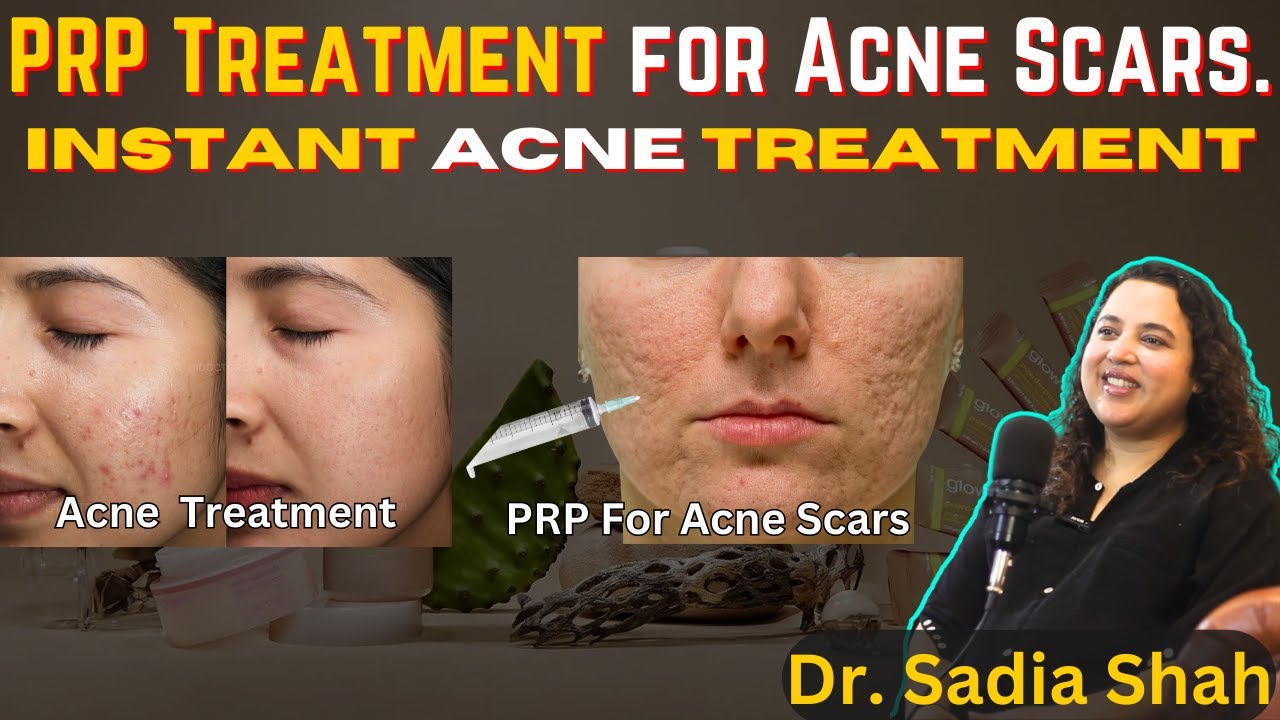 Best Treatment for Acne & Scars | PRP Treatment for Face and Benefits ...
