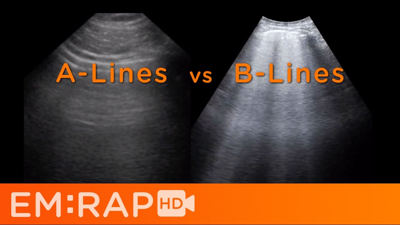 Ultrasound Of Pulmonary Edema Youtube