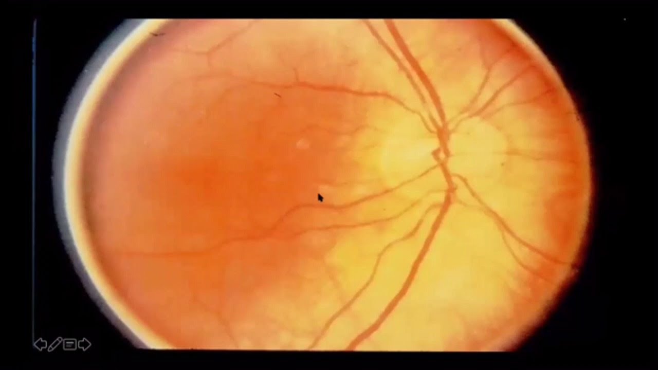 How to improve eye circulation. - YouTube