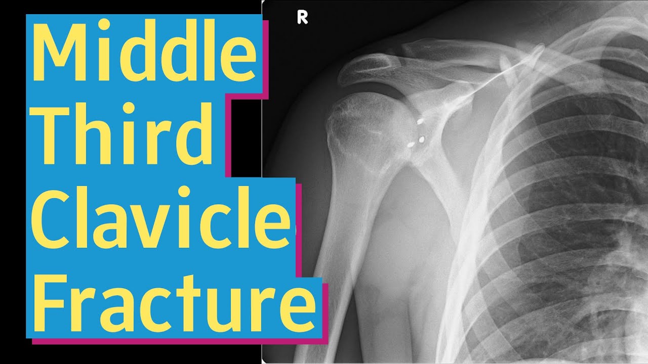 Mid Shaft Clavicle Fracture - YouTube
