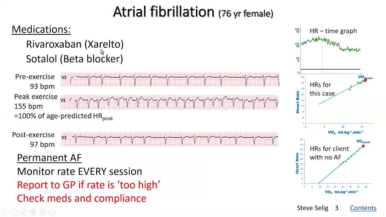 atrial fibrillation and exercise: part 3: case study - YouTube