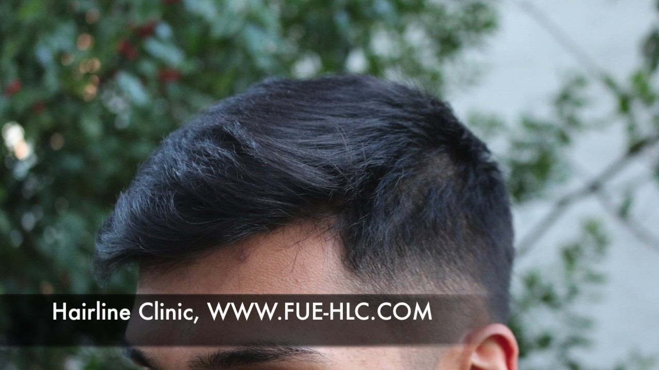 FUE Hair transplant, Hairtransplant turkey, Hairline lowering - YouTube
