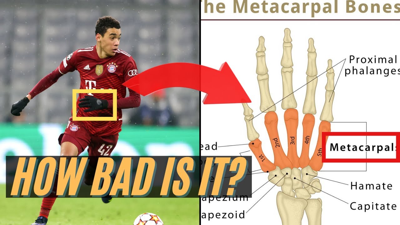 Expert Explains Jamal Musiala Injury (Hand Fracture) & Return Timeline ...