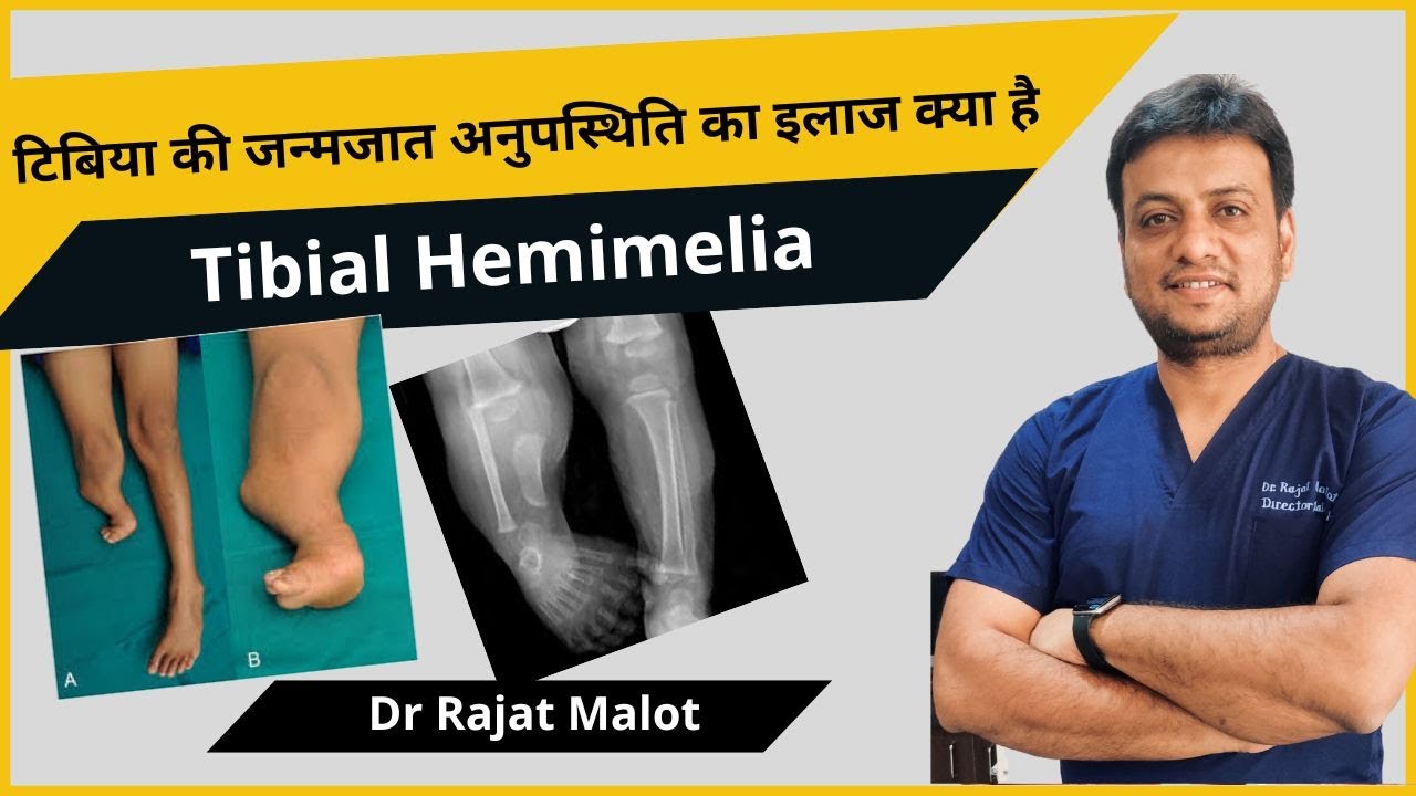 Tibial Hemimelia Tibial Hemimelia: New Classification And