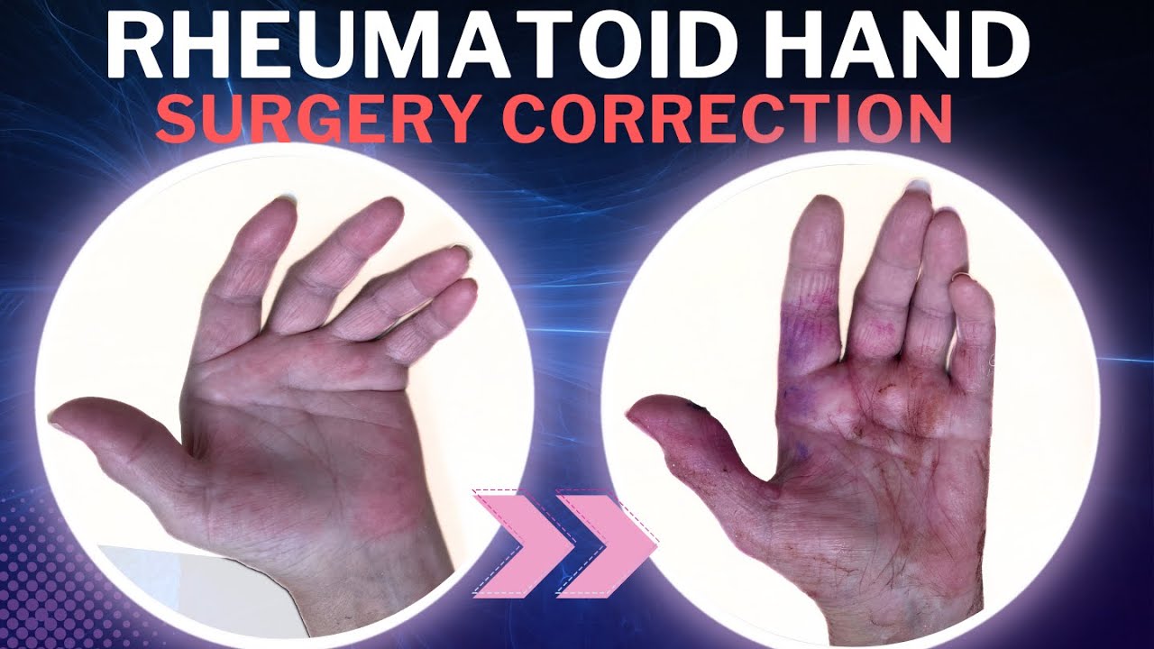 rheumatoid arthritis of hands transformation - YouTube