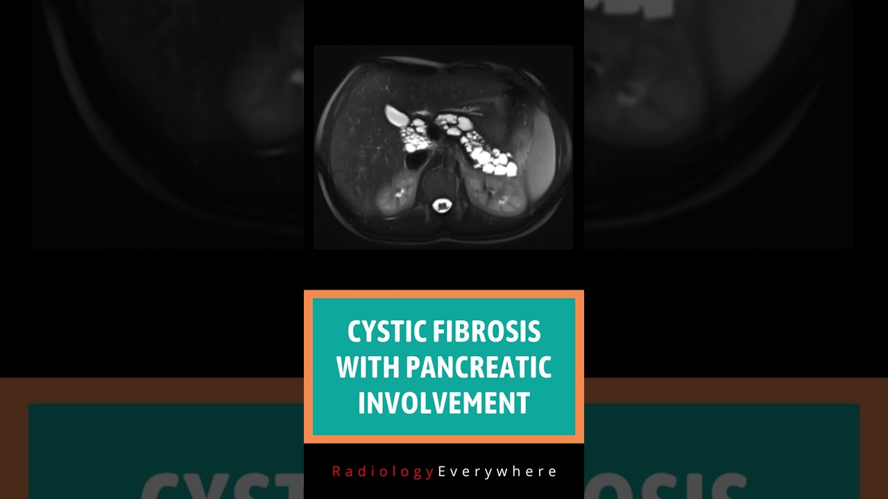 CYSTIC FIBROSIS WITH PANCREATIC INVOLVEMENT | Radiology Tutorials ...