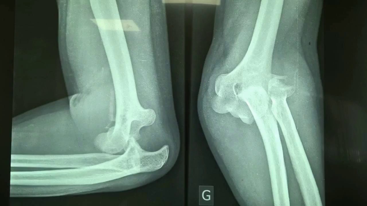 réduction d'une luxation de coude aux urgences/reduction of elbow ...