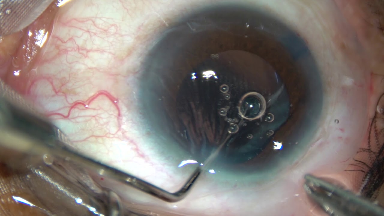 Posterior capsular catch, Zonular dialysis, Use of CTR - YouTube