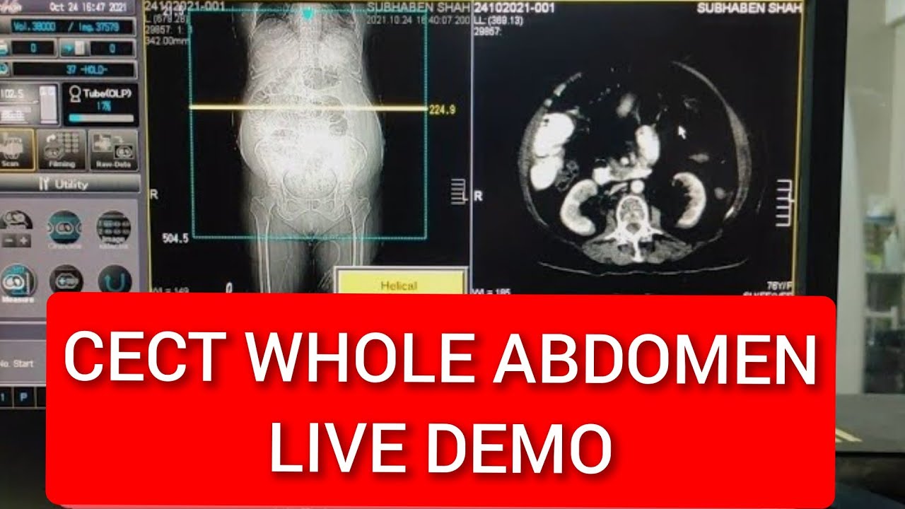 How to do CECT Abdomen. - YouTube