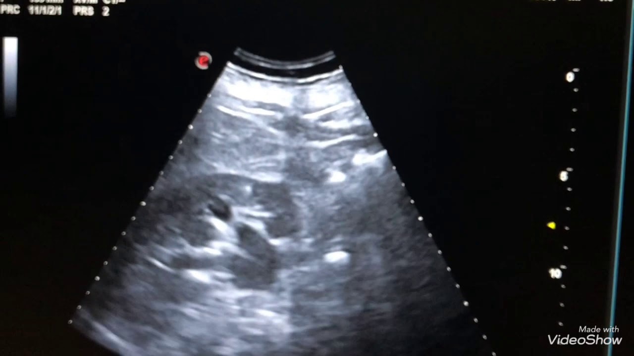 Hidronefrosis renal moderada a severa Moderate to severe renal ...