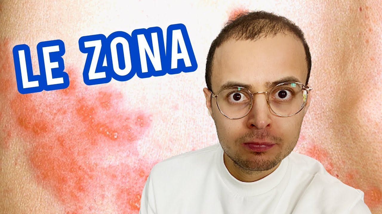 LE ZONA : une maladie très douloureuse ! 😖 - YouTube
