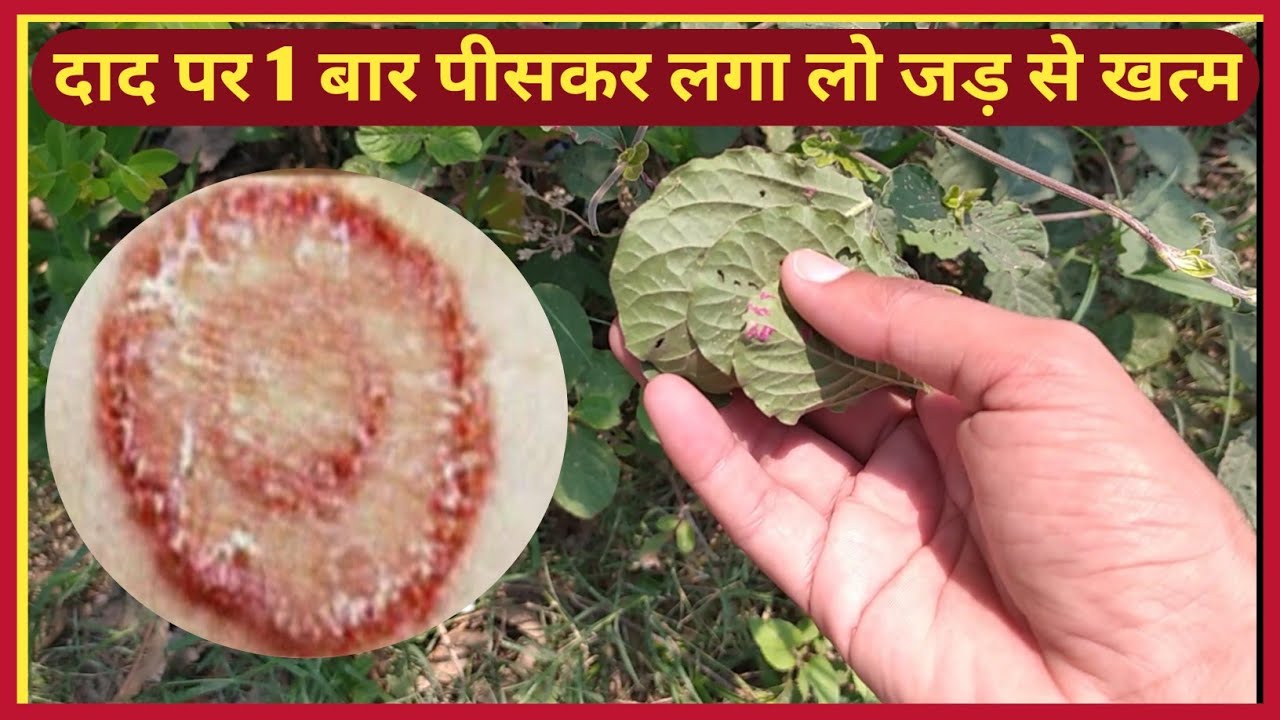 दाद खाज खुजली मात्र 1 बार पीसकर लगा लो जड़ से खत्म// Daad khaj khujli ...