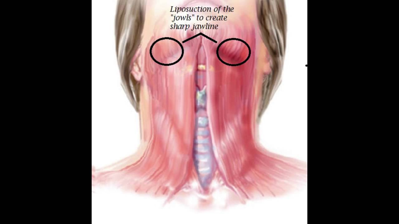 Learn about neck rejuvenation with platysmaplasty - YouTube