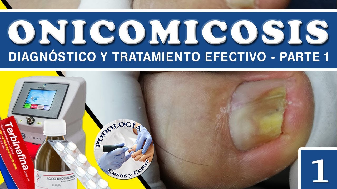 PARTE 1 - ONICOMICOSIS : Diagnóstico y Tratamiento Efectivo | Podología ...